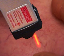 SDL100 Permanent Laser Hair Removal System for Medispa & Salon, best m ...