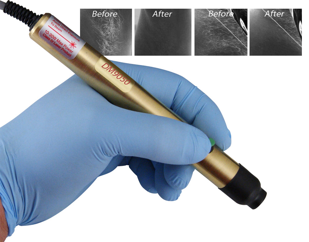 DM7050-DX permanent laser hair remover for back face body chest chin l ...